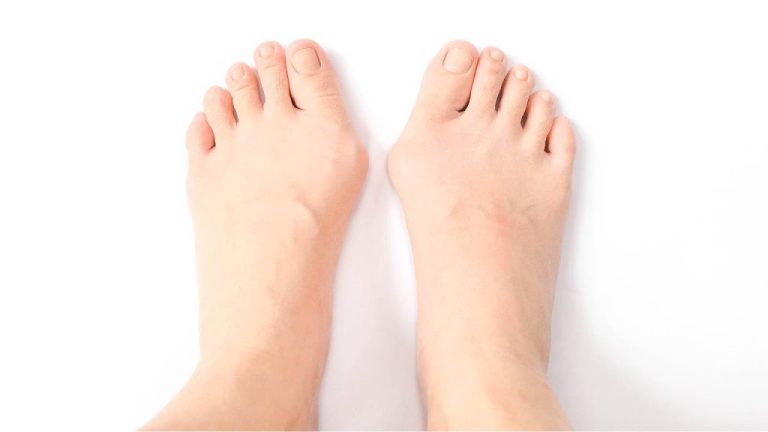 Juvenile Bunions | Causes & Management | Straits Podiatry