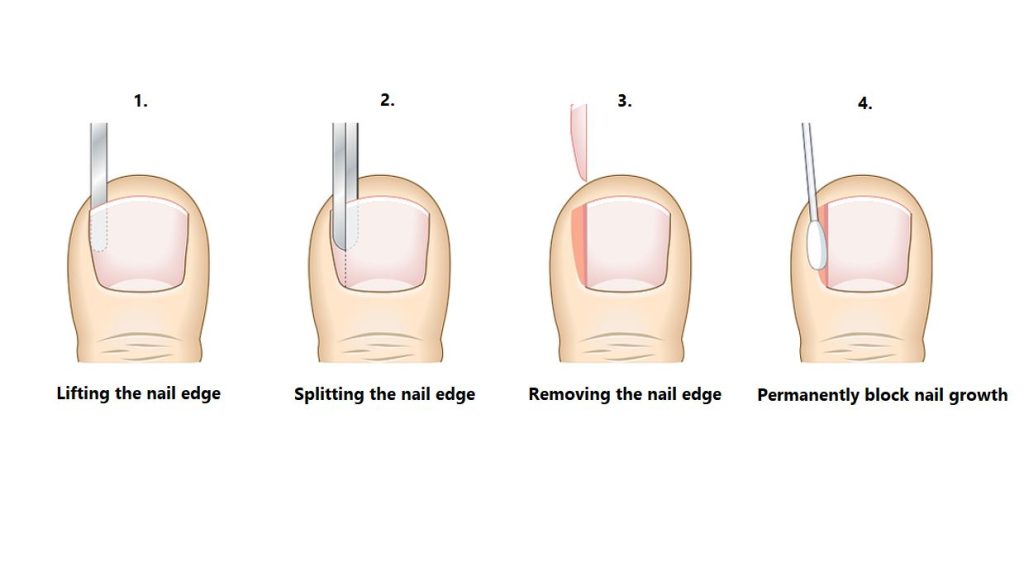 Partial Nail Avulsion Procedure | Straits Podiatry Singapore