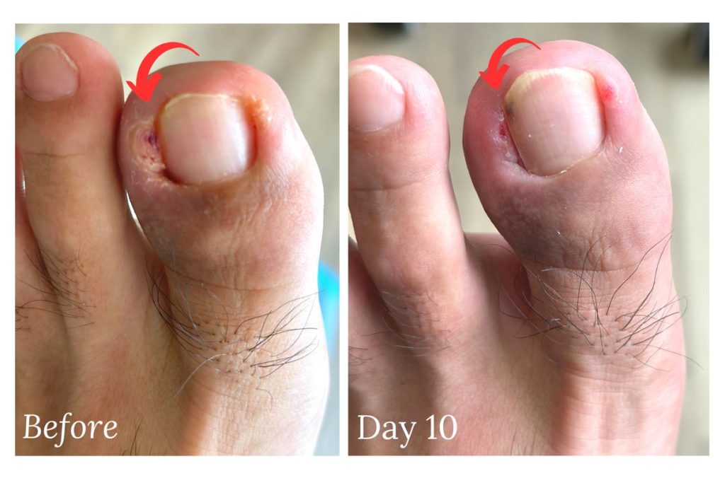 Partial Nail Avulsion Procedure | Straits Podiatry Singapore
